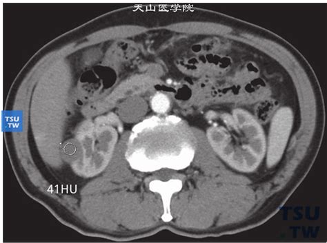 【附图】 Ct与mr对比，右肾乳头状肾细胞癌，皮髓质期ct参考值约41hu（2） 泌尿系统 天山医学院