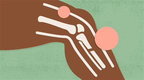 Il 6 Inhibitors For Rheumatoid Arthritis What To Expect