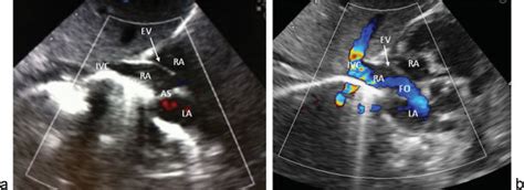 Eustachian Valve Echo Subcostal View Anatomy Of A Wrong Diagnosis