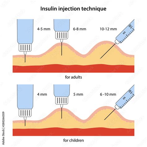 Youtube Insulin Injection Technique At Frieda Krull Blog