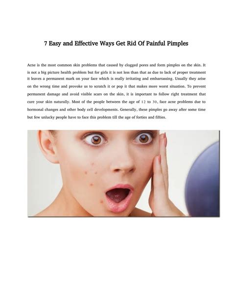 PPT Easy And Effective Ways Get Rid Of Painful Pimples PowerPoint Presentation ID