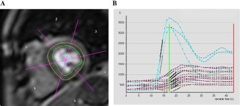 Semi Quantitative Perfusion Analysis Semi Quantitative Perfusion Download Scientific Diagram