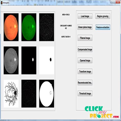 An Efficient Automated System For Detection Of Diabetic Retinopathy