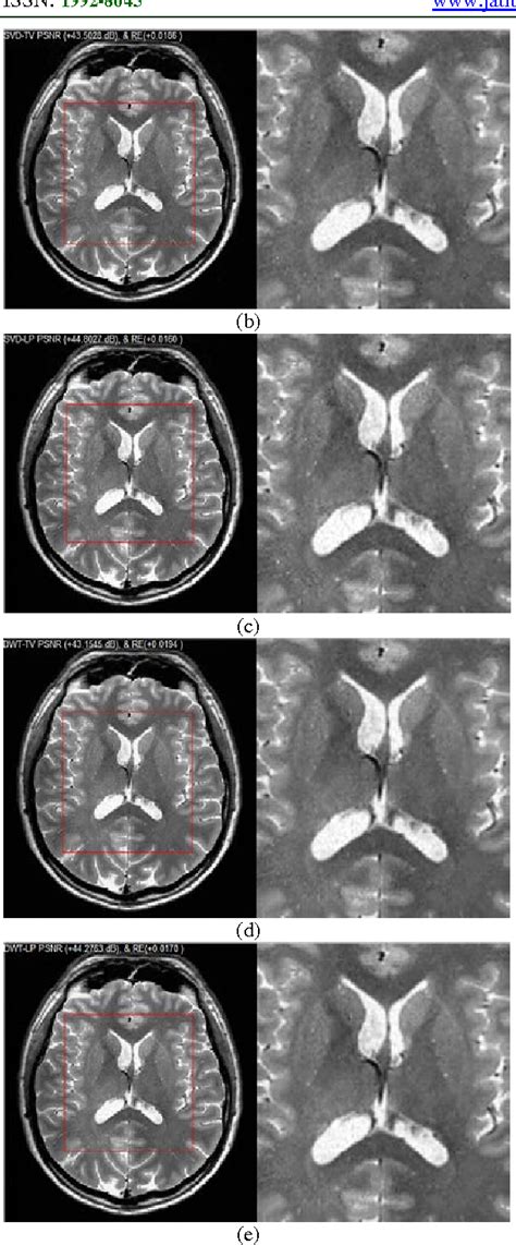 Pdf Parallel Mri Reconstruction Using Svd And Laplacian Transform Based Sparsity