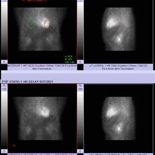 Positive Pyrophosphate Scan Confirming Amyloidosis Download Scientific Diagram