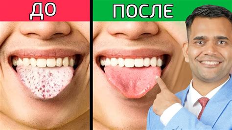 КАНДИДА УЙДЁТ ЕСЛИ ПРИНИМАТЬ ЭТО Youtube