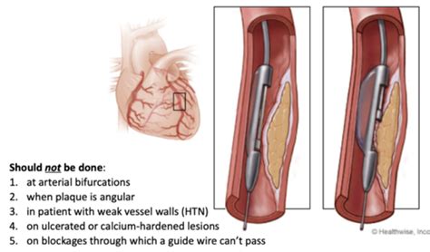 Cath Lab VFIB VTACH Flashcards Quizlet