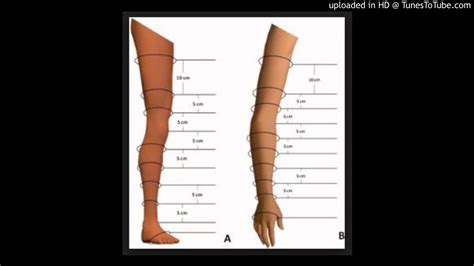 Leg Edema Measurement At Ricardo Alba Blog