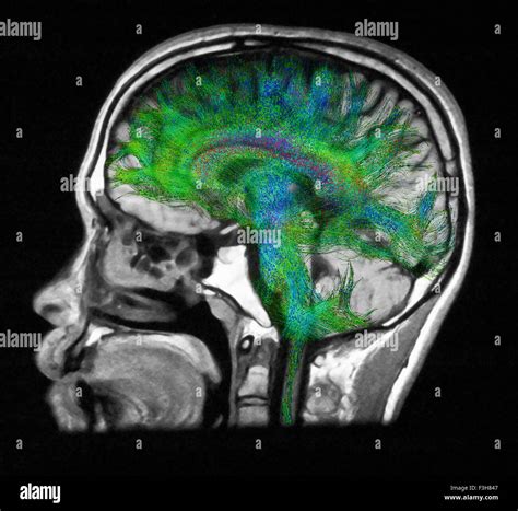 Diffusion MRI Also Referred To As Diffusion Tensor Imaging Or DTI Of