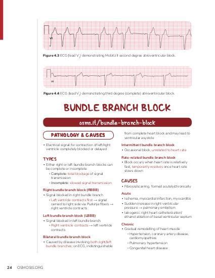 Bundle Branch Block Osmosis