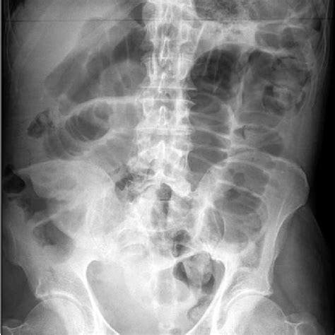 Maculopapular Rash Involving The Abdomen Download Scientific Diagram