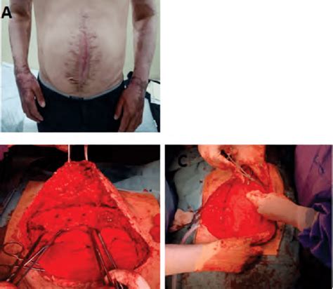 Case 5 A Aspect Before Abdominal Wall Reconstruction B Component Download Scientific