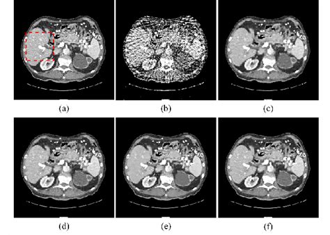 Figure 1 From Sparse View Ct Reconstruction Via Convolutional Sparse