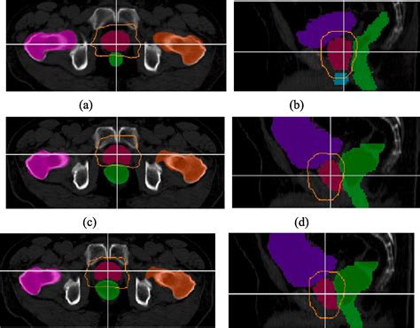 A New Target Localization Method For Image Guided Radiation Therapy Of Prostate Cancer Physica