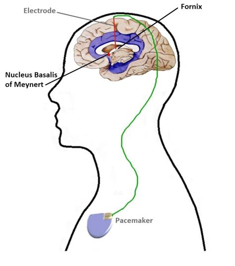 Markers Deep Brain Stimulation At Daryl Pulver Blog