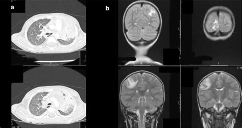 Chest Ct Scan Of Patient With Mycobacterial Infection And Brain Mri