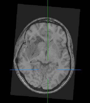 Output MRI Images Have Value 0 Almost Everywhere After Resampling