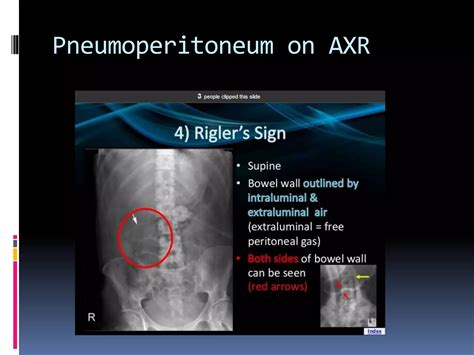 Interpret Axr And Imaging Of Gist System Pptx