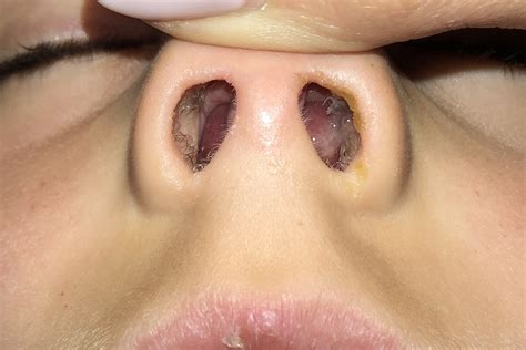 Intranasal Septal Hematoma A Diagnosis Not To Miss The Journal Of