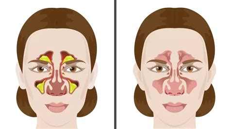 5 Easy Ways To Remove Mucus And Phlegm Naturally Artofit