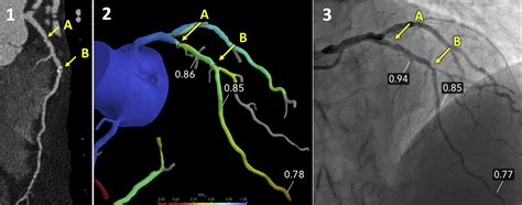 Ct Derived Fractional Flow Reserve Ct Ffr In The Evaluation Of