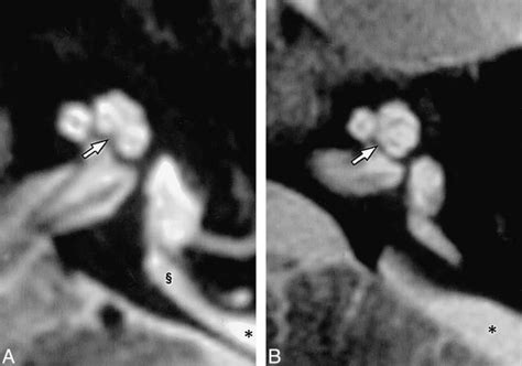 Modiolar Deficiency With Leds A Axial T2 Weighted Fse Mr Image Of The