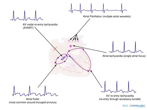 File Svt Overview Svg Ecgpedia