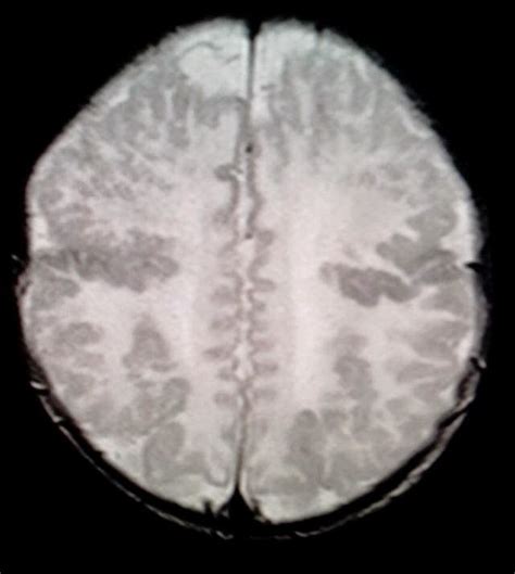 Polymicrogyria Mri Sumers Radiology Blog