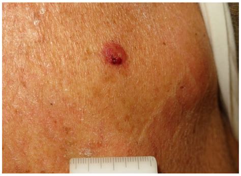 A Review Of Non Invasive Skin Imaging In Merkel Cell Carcinoma