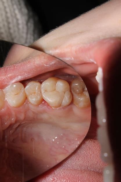 87000 Teeth Damage Pictures