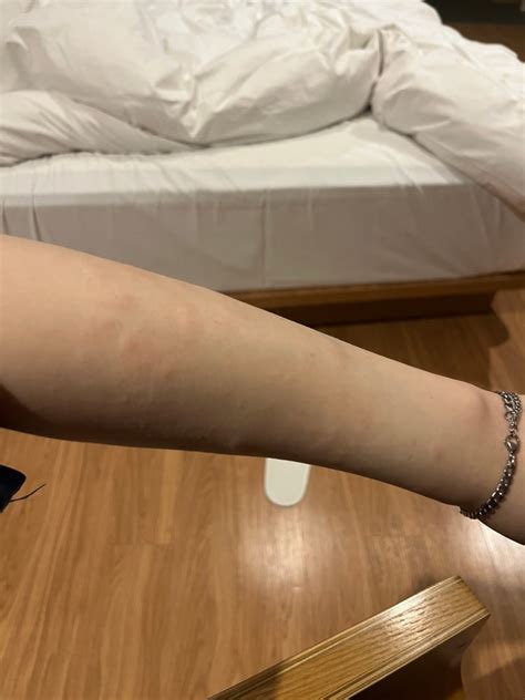 햇빛 알레르기 인가요 지식in