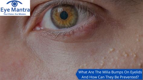 Milia Bumps On Eyelids Home Remedies For Eyelid Bumps