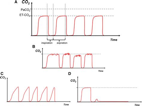 Capnography Waveforms Basic Interpretation In Neonatal Intensive Care Pmc