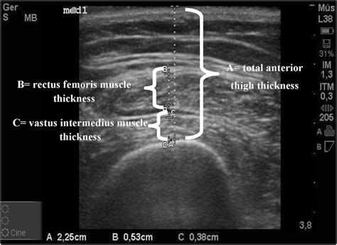 Ultrasound Measurement Of Rectus Femoris Crosssectional