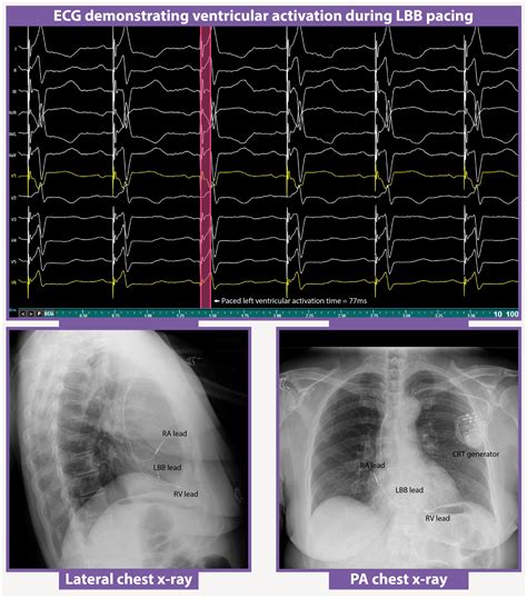 Loss Of Capture Of Conduction System Pacemaker Caused By Fibrosis
