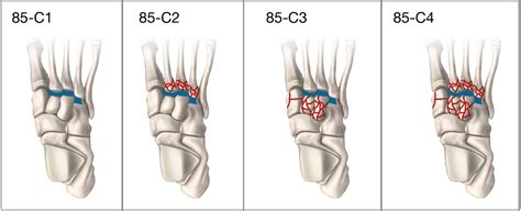 Epidemiology Classification And Treatment Of 2084 Lisfranc Injuries