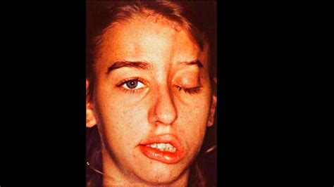 Scleroderma Medical Powerpoint Presentation Youtube