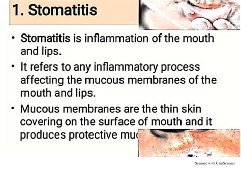 Stomatitis Pdf