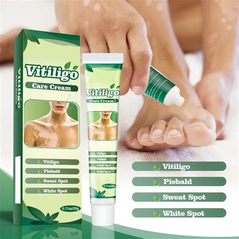 Витилиго Мазь купить с доставкой по выгодным ценам в интернет магазине Ozon 1272622765