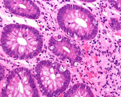Ibrutinib Approved For Pediatric Patients With Chronic Graft Versus Host Disease Oncology Data