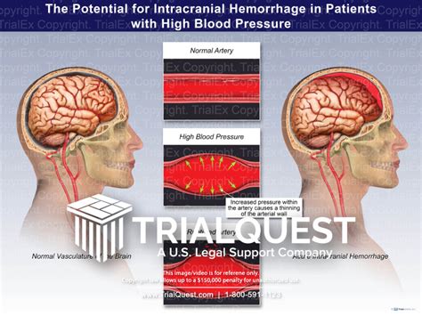 The Potential For Intracranial Hemorrhage In Patients With High Blood