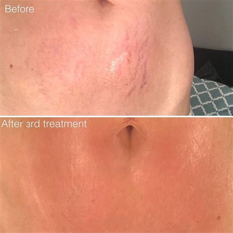 Microneedling Stretch Marks Does It Work And How