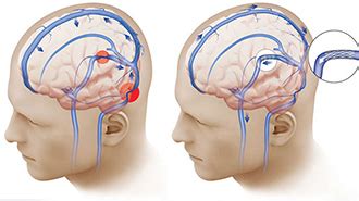 Venous Sinus Stenting Program Weill Cornell Brain And Spine Center