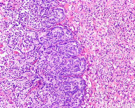 肾细胞癌，未分类