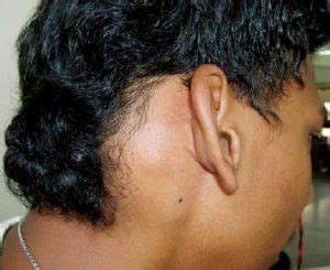 Ear Cancer Temporal Bone Pain A Simple Best Guide