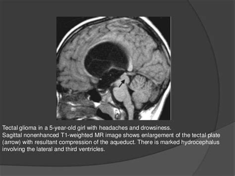 Tectal Plate Anatomy