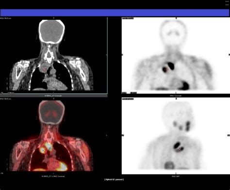 Parathyroid Cystic Adenoma Causing Primary Hyperparathyroidism And