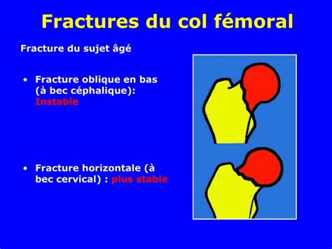 Ppt Fractures Du Col Powerpoint Presentation Free Download Id5936168