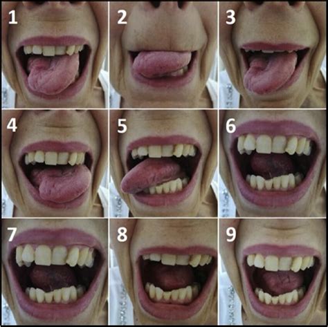 The Nine Movements Of The Tongue Motility Assessment In Patient Who Download Scientific Diagram