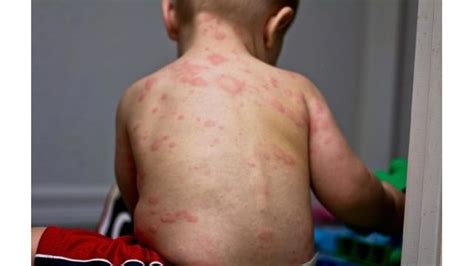 Менингококкт халдвараас хэрхэн урьдчилан сэргийлэх ЗӨВЛӨГӨӨ